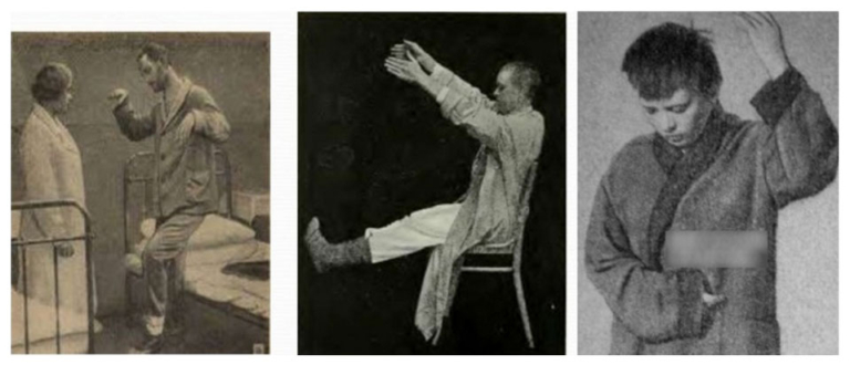 Ступор, кататония, кататонический синдром - Medside.ru