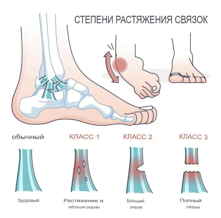 Боли в ногах: причины и лечение боль в икрах ног, мышцах, пальцах ...